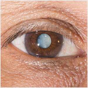 Cataract Surgery - Monofocal Lens